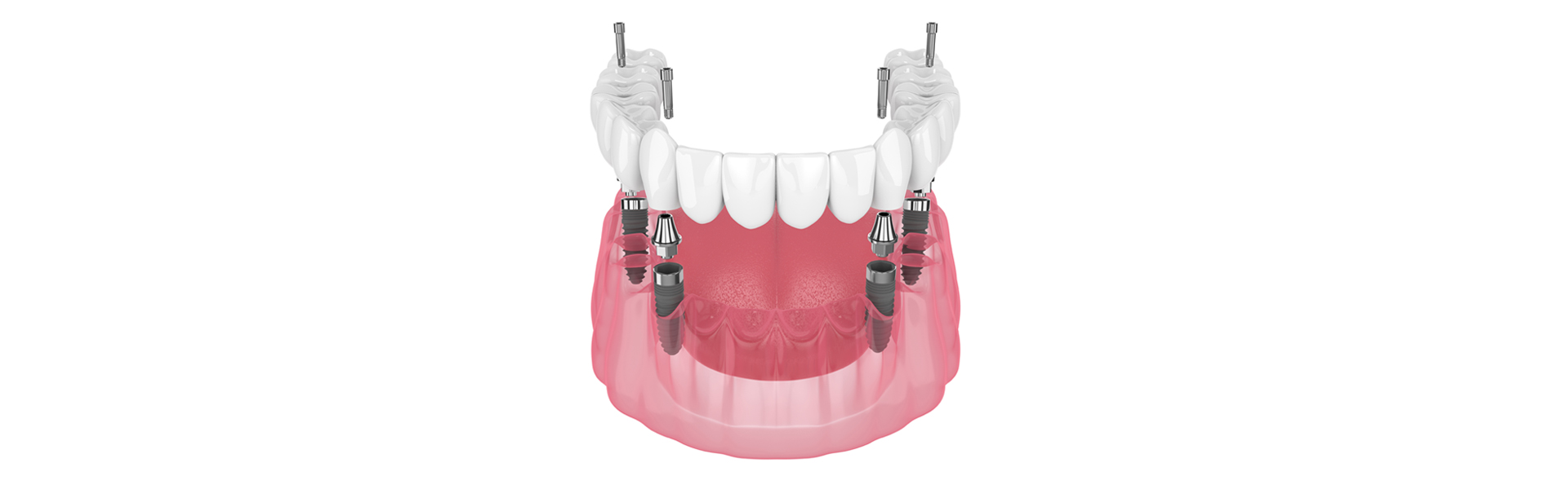 All-on-4 Dental Implants: A Long-Term Solution for Missing Teeth - West Palm Beach Dentist ...